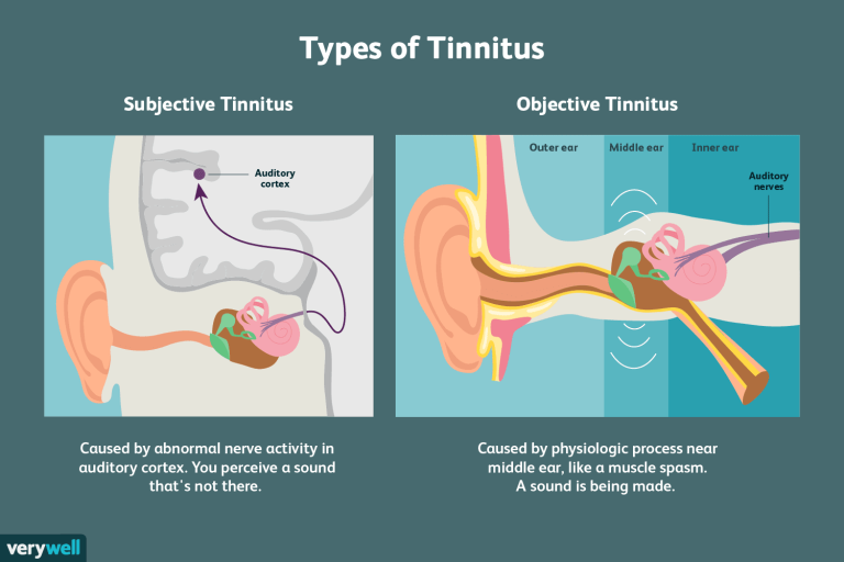 All about tinnitus